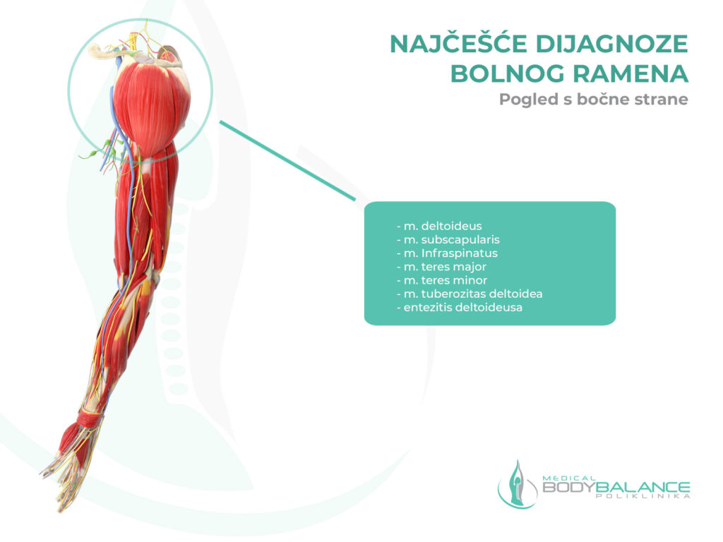 Zašto Vas boli rame? (Bol u ramenu i preko 100 mogućih dijagnoza ramena ...