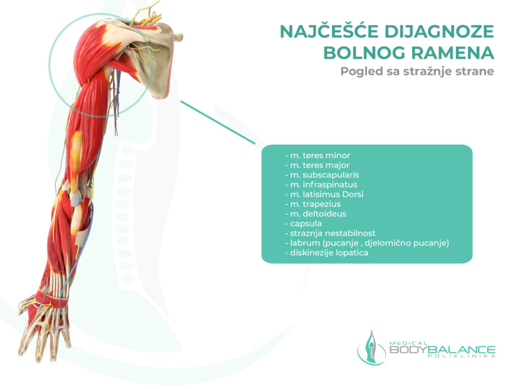 Zašto Vas boli rame? (Bol u ramenu i preko 100 mogućih dijagnoza ramena ...