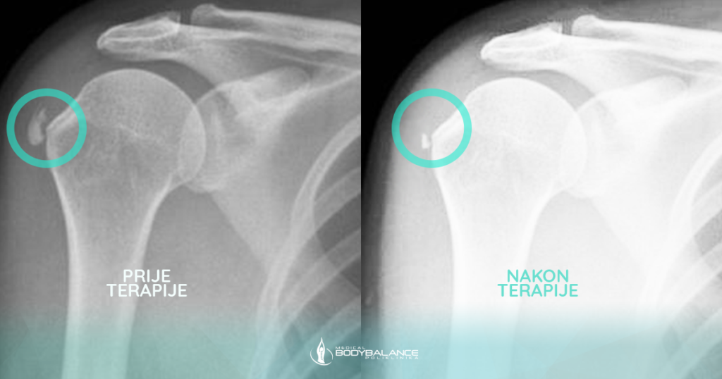 Kako izliječiti kalcifikat? - Poliklinika Medical Body Balance