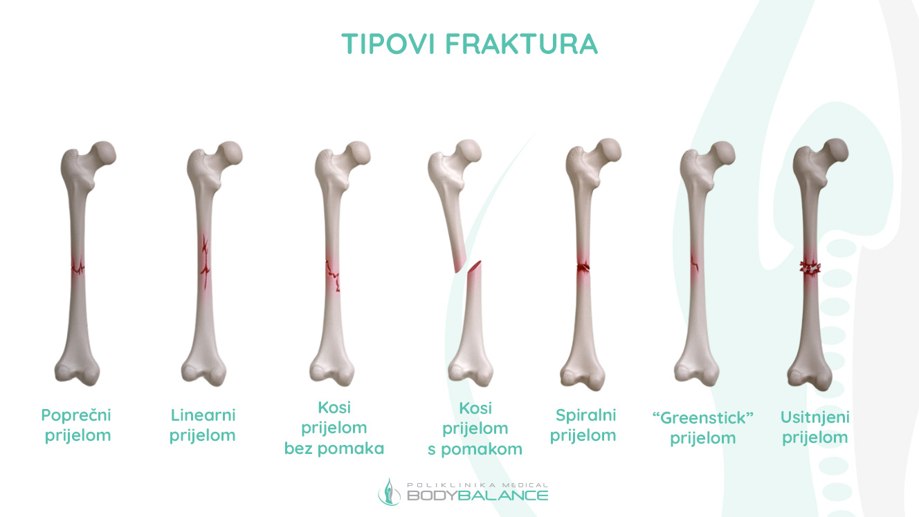 Rehabilitacija nakon prijeloma kosti - Poliklinika Medical Body Balance